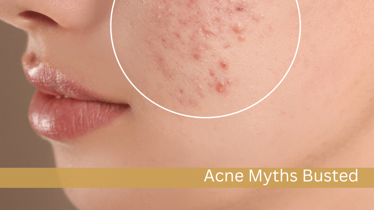 Acne Myths Busted Clearing Up Common Misconceptions About Acne